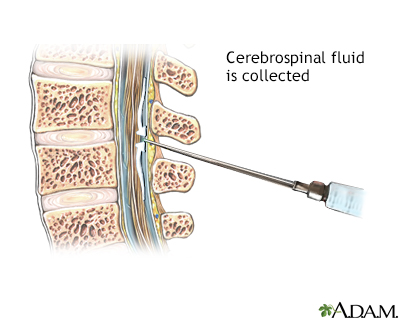 Cerebrospinal fluid (CSF) collection