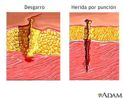 Spanish HIE Multimedia - Desgarro versus herida penetrante